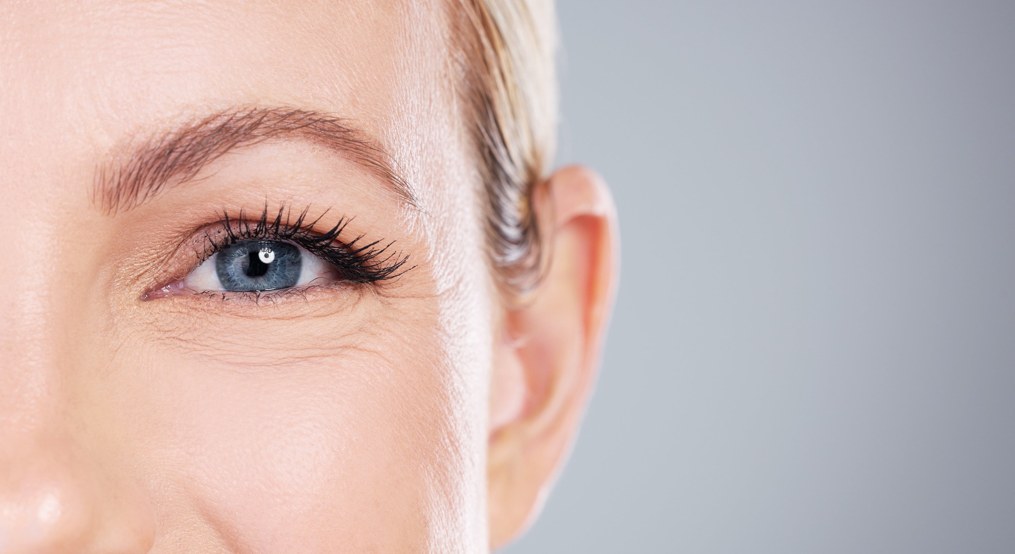 Crows Feet – West Michigan Plastic Surgery